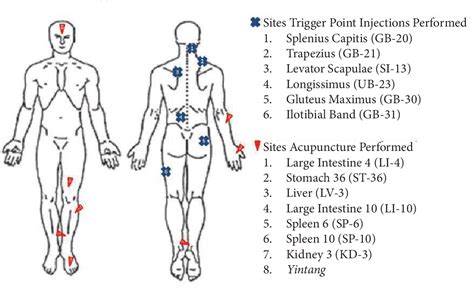 Figure 1 From Acupuncture And Trigger Point Injections For Fibromyalgia East West Medicine Case