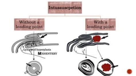 Intussusception Management And Complications Ppt