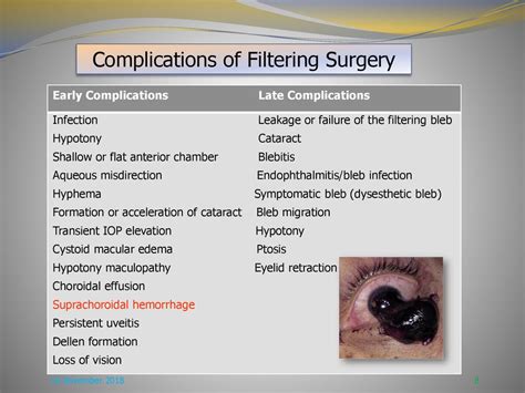 Filtering Bleb Infection At Jill Baker Blog