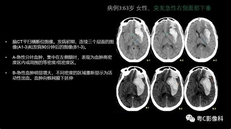 过去10年新命名的10大神经影像学征象 医学界 助力医生临床决策和职业成长
