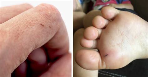 Splinter Removal Quick Tips To Relieve Pain Homemaking Com