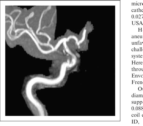 Figure 3 From Pipeline Embolization Device Deployment Via An Envoy