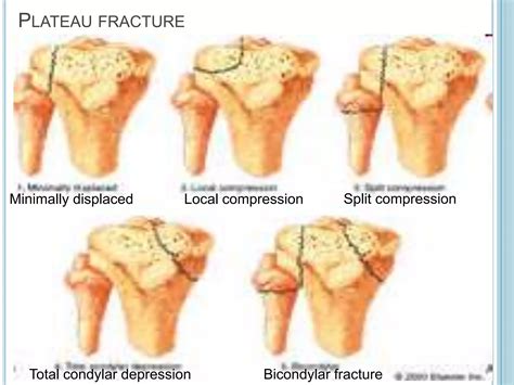 Proximal Tibia Fracture Ppt