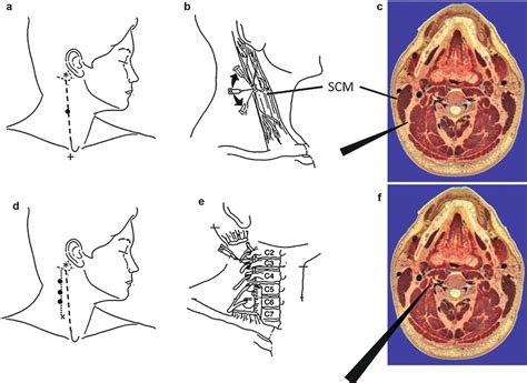 Cervical Plexus Block