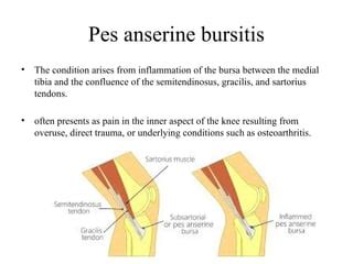 Popliteal Cyst Presentation In The Knee Pptx