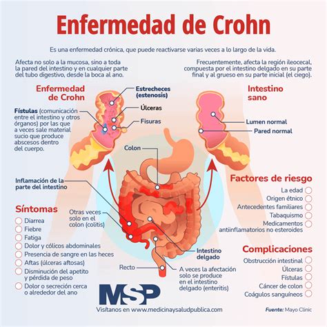 Enfermedad De Crohn Infografía