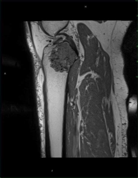 Enchondroma Tibia Musculoskeletal Radiology Case Studies Ctisus Ct Scanning Enchondroma Tibia Musculoskeletal Radiology Case Studies Ctisus Ct Scanning