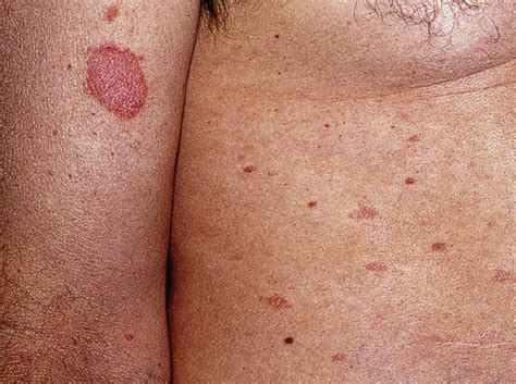 Pityriasis Rosea Anesthesia Key