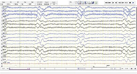 Follow Up Eeg Displaying Frequent Periodic Bursts Of Generalized