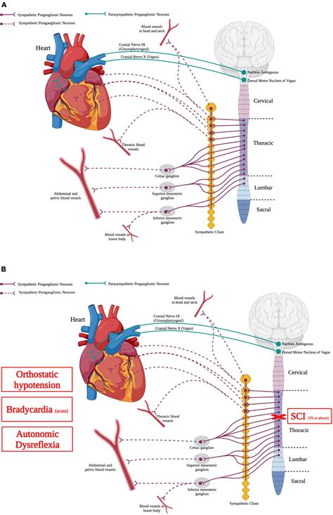 Autonomic Dysreflexia Associated With Cervical Spinal Cord 47 Off