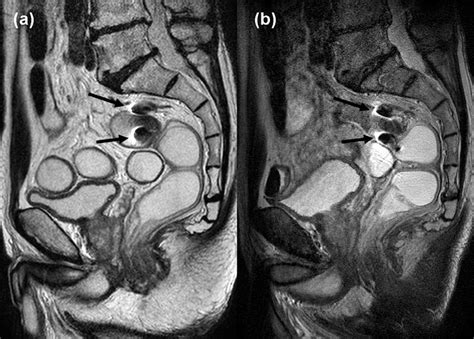Motion Artifact And Susceptibility Effect Pelvic Mr Images Were