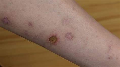 Sarcoidosis School Of Medicine