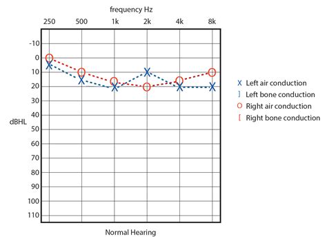 Hearing Loss Enteducationswansea Hearing Loss Enteducationswansea