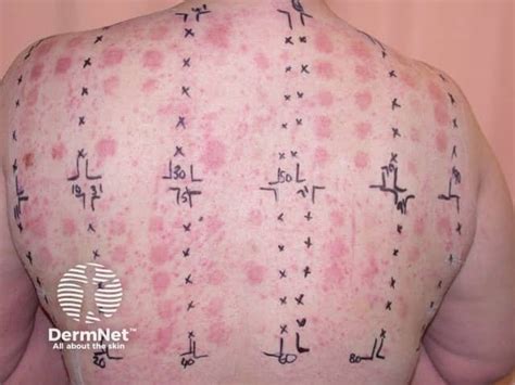 Patch Tests Skin Contact Allergy Tests Explained DermNet