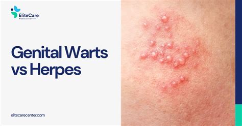 Difference Between Genital Warts And Herpes What You Need To Know