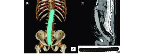 Computed Tomography Scans Showing A 56 Year Old Man With A Sex Toy In