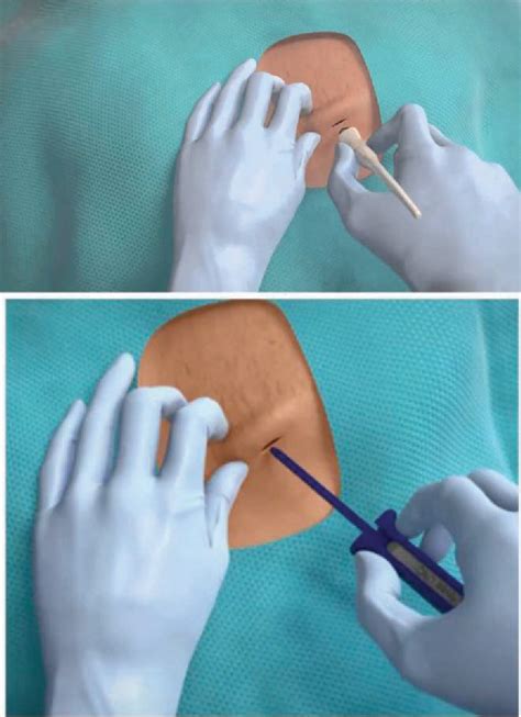 Implantable Loop Recorder Reveal Device At Evelyn Wegner Blog