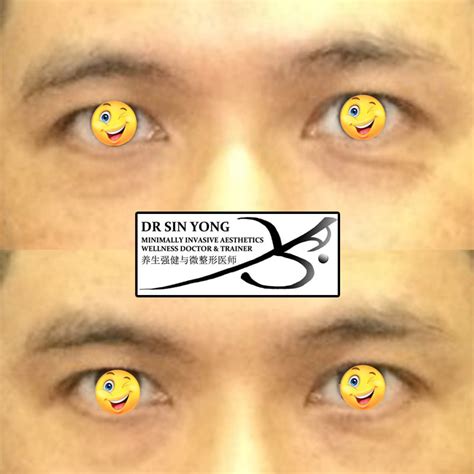 Rvr Prolift Dr Sin Yong
