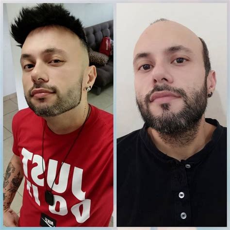 Pin On Hair Loss Man