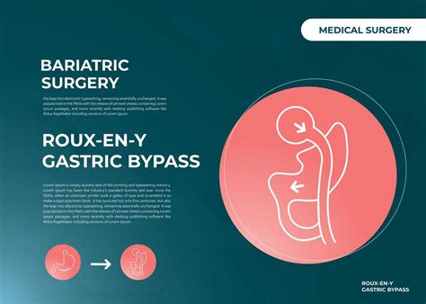 Roux En Y Gastric Bypass Rny Weight Loss Surgery Vector Illustration