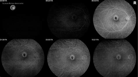 Acute Idiopathic Maculopathy December 2022 Illinois Retina