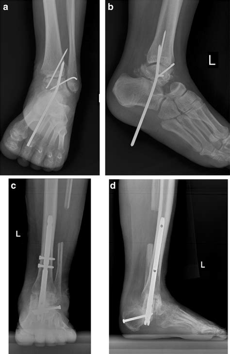 Open Pantalar Dislocation With Lost Talar Head And Medial Malleolus A Download Scientific
