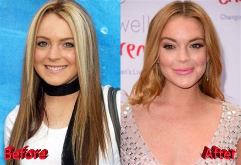 Lindsay Lohan Plastic Surgery Is She Done With It