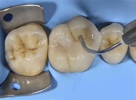 落馬洲口岸牙科維港口腔科普蛀牙補牙後比補牙前更痛 維港口腔連鎖