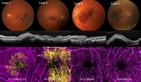 Detection Of Macular Neovascularization In Eyes Presenting With Macular