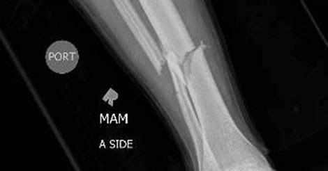 Tibia Fracture Questions About The Injury Treatment And Recovery Dr Geier