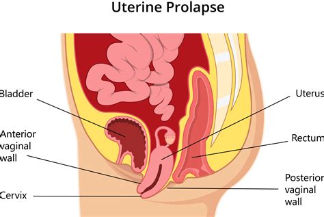 Uterus Prolapse 3rd Degree Uterine Prolapsed Youtube
