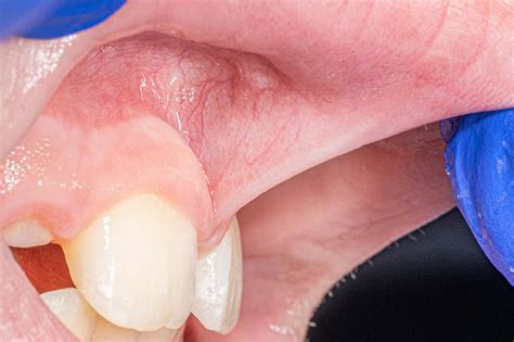 Frenectomy — Michigan Implants And Periodontics