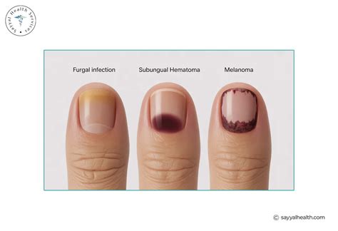 How To Check Your Nails For Melanoma
