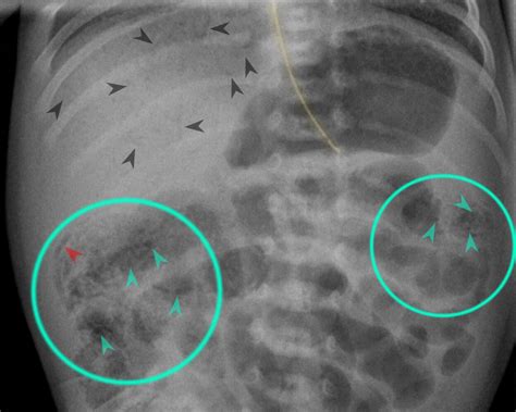 Necrotizing Enterocolitis Symptoms