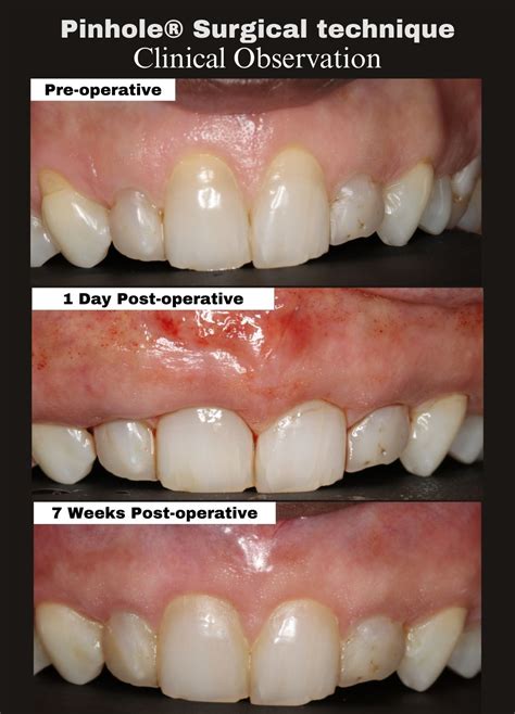 Clinical Observation — Gingival Recession Pinhole® Surgical Technique