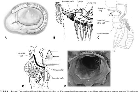 Figure 2 From Current And Evolving Strategies In The Management Of Severe Mitral Annular