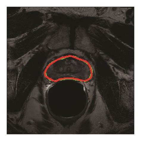 Parts Of Mri Prostate Images Segmentation Results The Red And Green Download Scientific