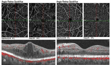 Vd On 6 × 6 Mm Octa Images In The Different Morphological Patterns Of Download Scientific