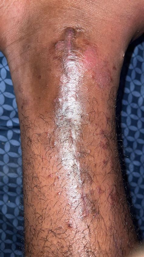 Fractured Tibia And Fibula R Brokenbones