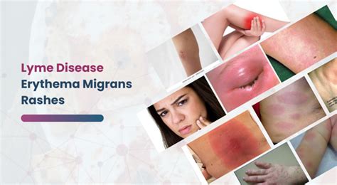 Lyme Disease Erythema Migrans Rashes Dataset For Ai And Medical