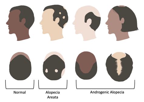A Clinicians Guide To Alopecia Diagnosis Treatment And Prevention Practicaldermatology