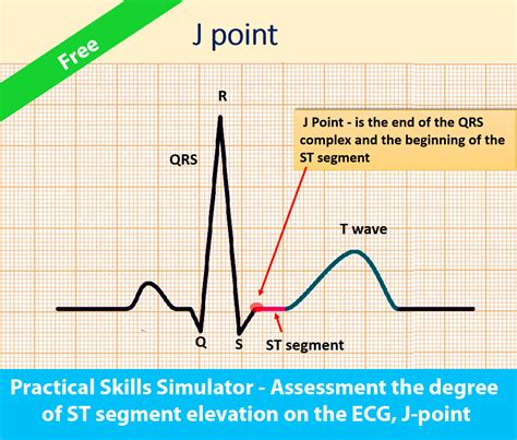 Assessment Of The Degree Of St Segment Elevation On The Ecg J Point