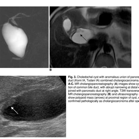 Choledochal Cyst Was Described According To Todanis Classification Download Scientific Diagram