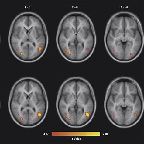 Functional Magnetic Resonance Imaging Group Differences In Visual Areas