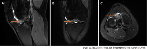 Recurrent Cyclops Lesion After Primary Anterior Cruciate Ligament