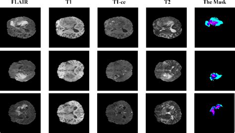 Figure 1 From An Automatic Brain Tumor Segmentation Using 3d Residual U