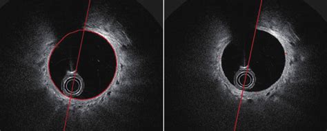 Analysis Of The OCT Records Analysis Of The OCT Records Was A