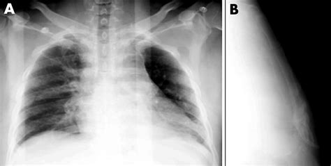 A Case Report Of An Unusual Sternal Fracture Emergency Medicine Journal