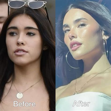 Madison Beer Cheek Fillers Plastic Surgery Before And After Face