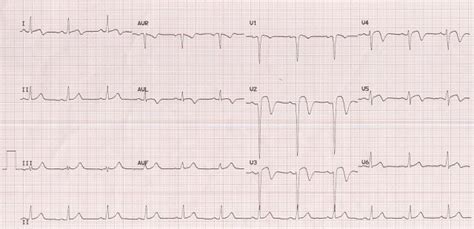 Pardee Sign On Ecg In Acute Myocardial Infarction All About Cardiovascular System And Disorders